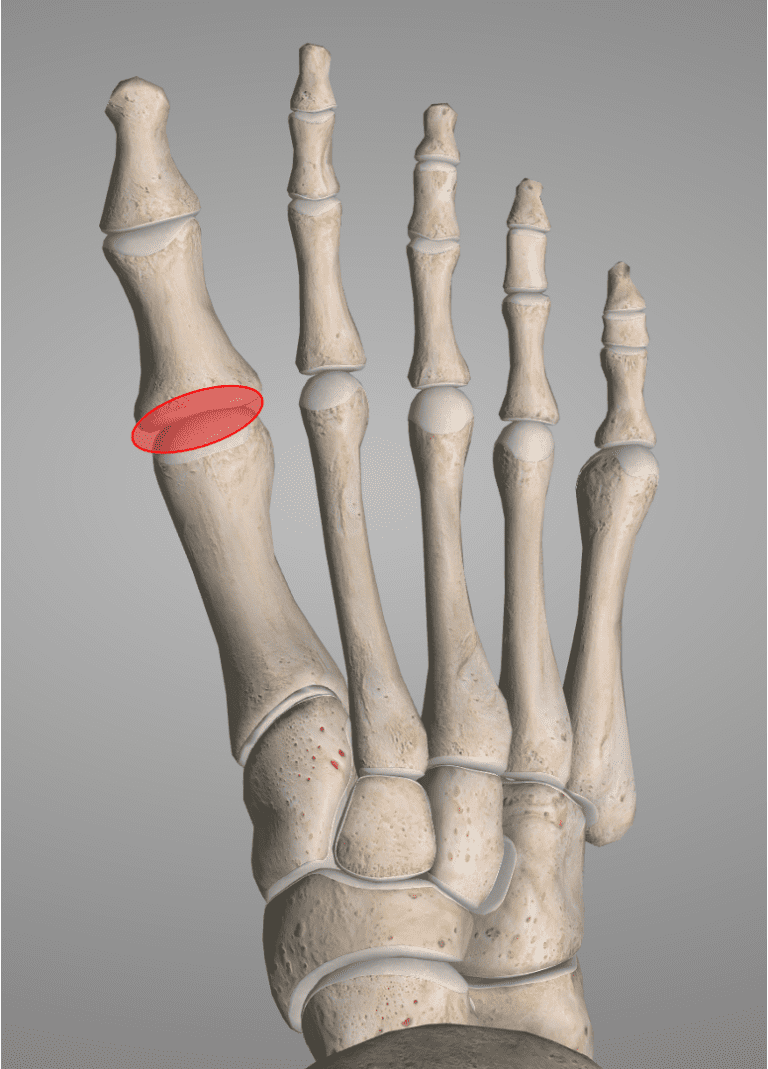 Hálux rígido: o que é, sintomas e tratamentos