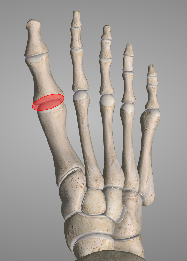 Hálux rígido: o que é, sintomas e tratamentos