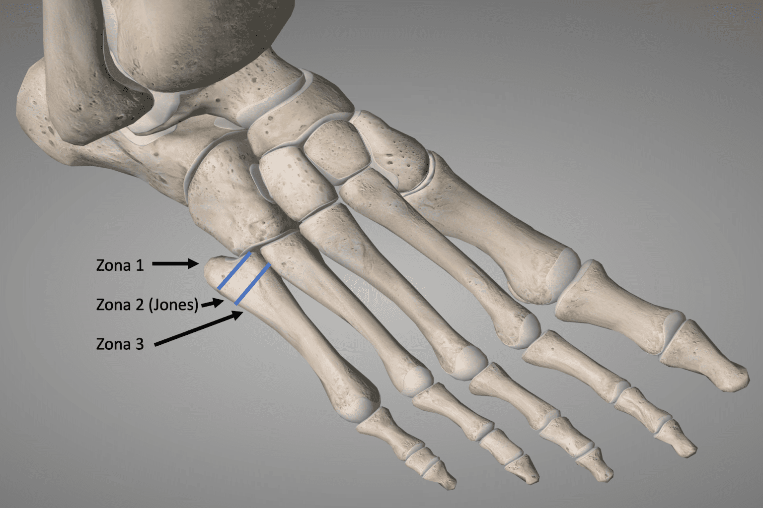 O que é fratura de Jones? - Dr. Guilherme Honda
