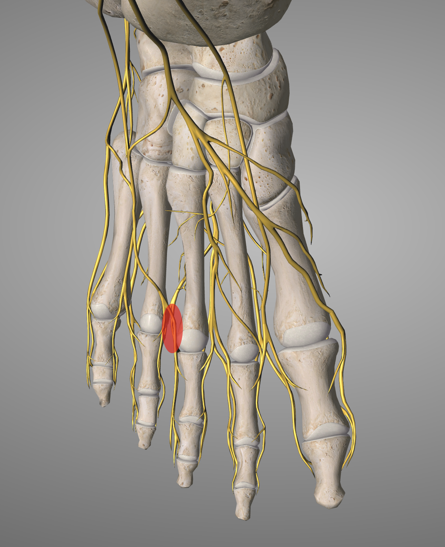 O que é Neuroma de Morton? - Dr. Guilherme Honda